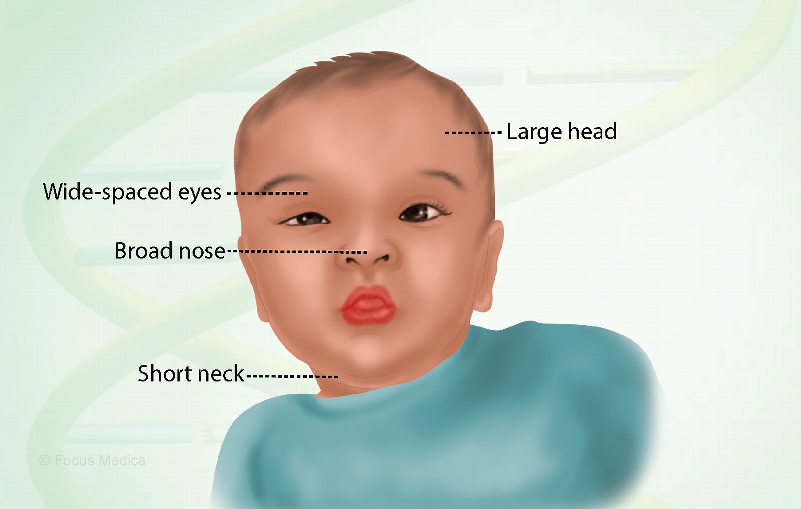 Noonan Syndrome Webbed Neck