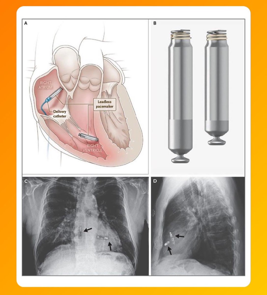 Nueva era de los marcapasos. Marcapasos sin electrodos Te lo cuento en ...