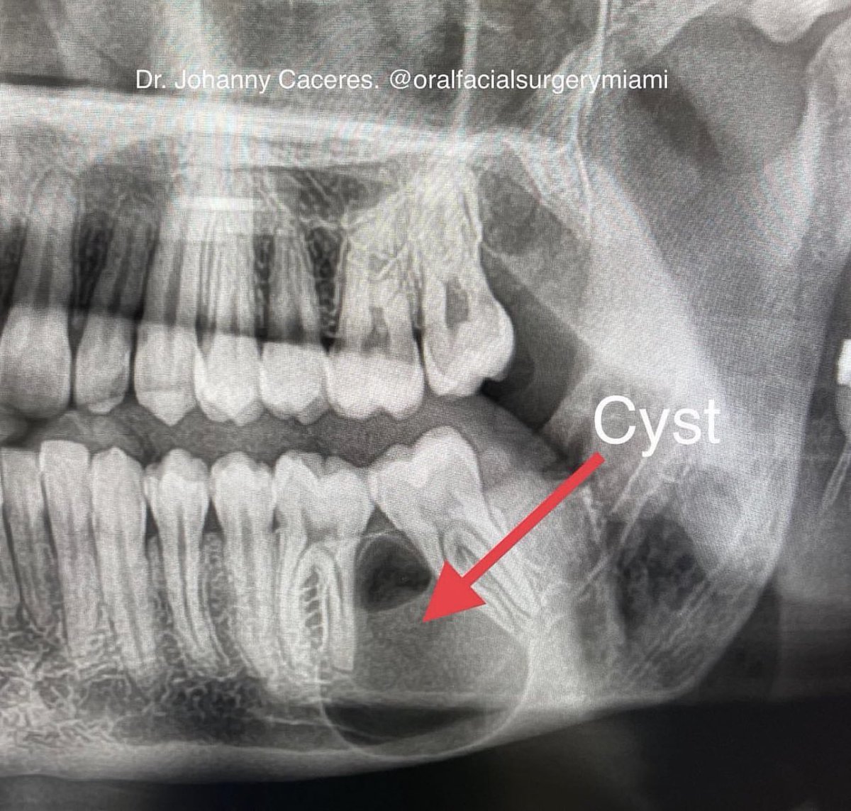 عن طب الأسنان | AboutDent on Twitter: "Enucleation of and curettage of mandibular cyst ...