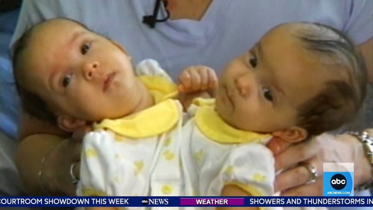 Conjoined Twins Erin And Jade