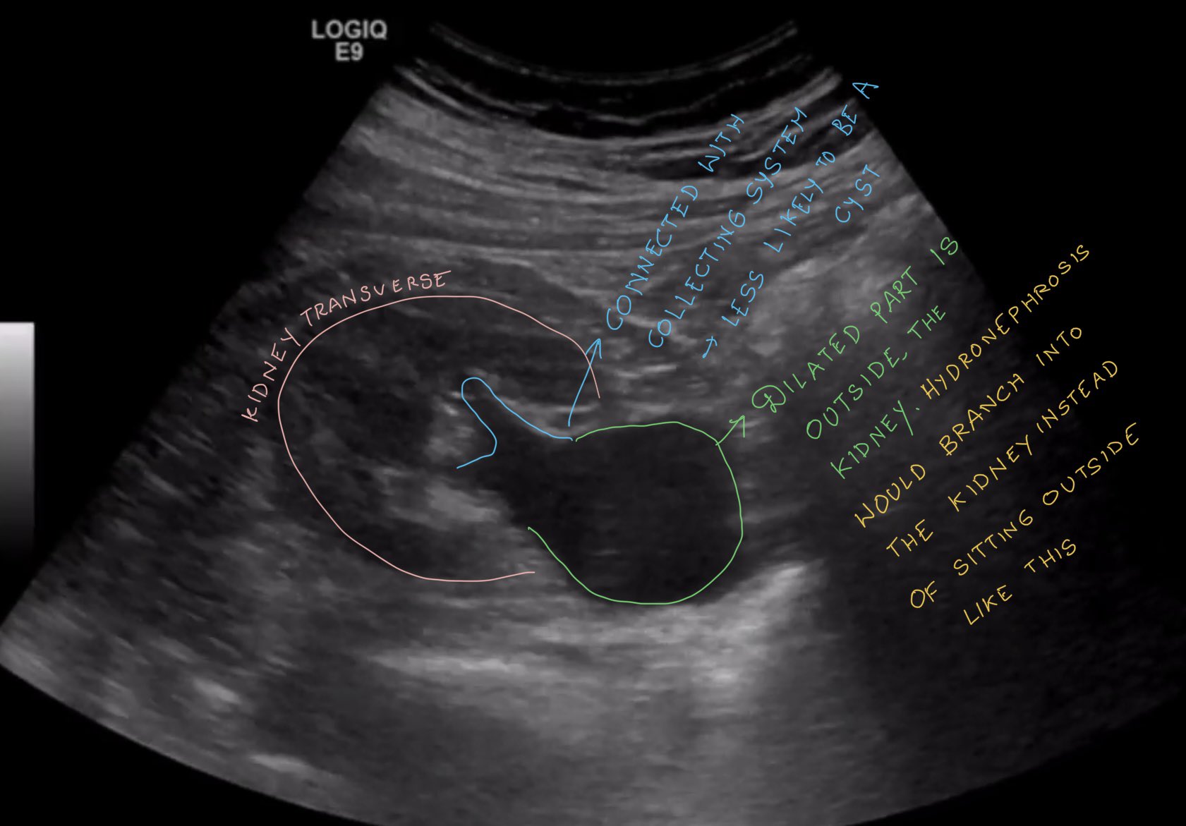 Extrarenal Pelvis