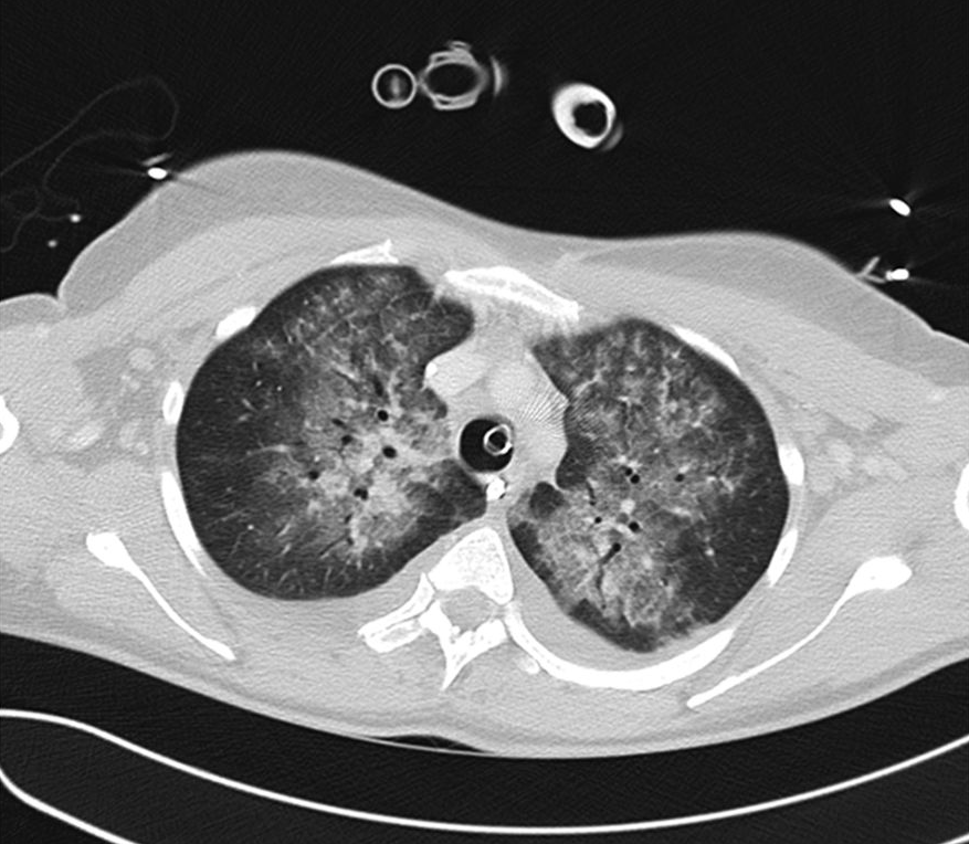 😱Emergencies in hematology😱 Hyperleukocytosis and leukostasis A short 🧵 ...