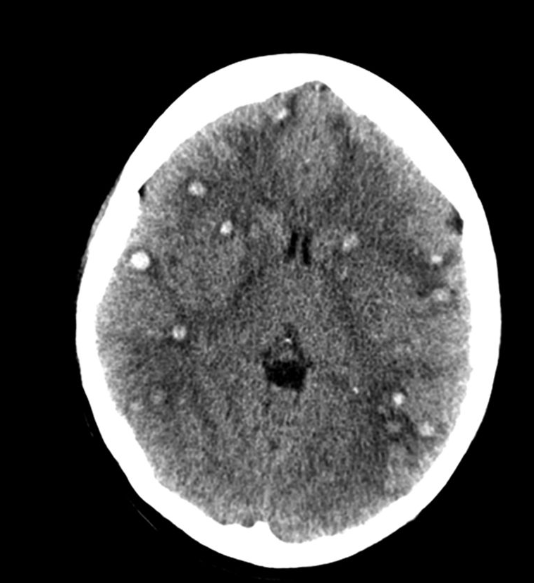 😱Emergencies in hematology😱 Hyperleukocytosis and leukostasis A short 🧵 ...