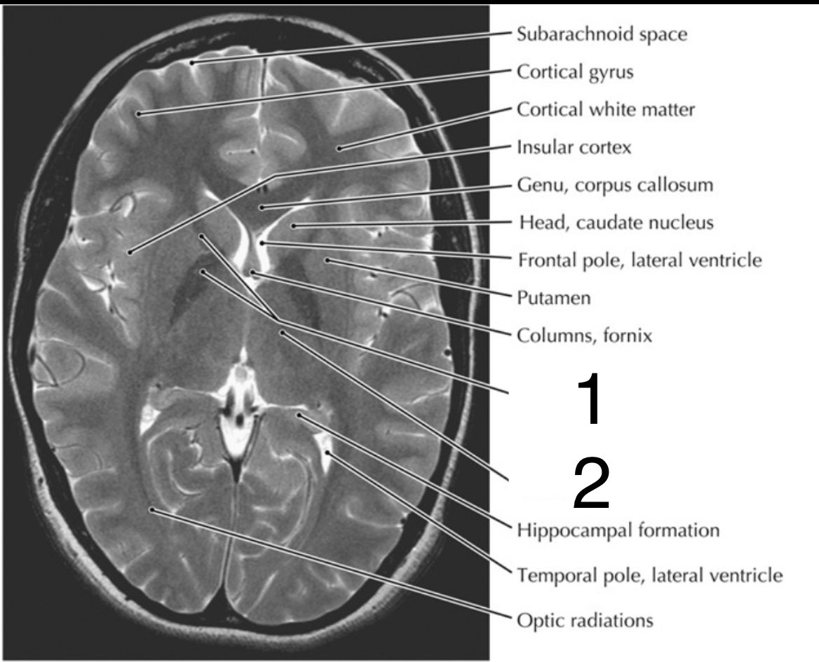 Brain Mri Labeled Brain Scanning | MRI, CT & PET Imaging | Britannica