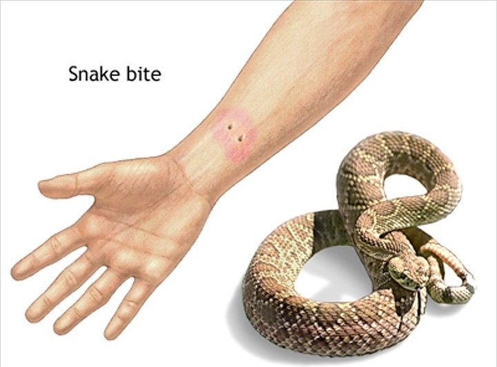 Snake bite, First Aid Tips👉 - Thread from Dr. Chiro Emmanuel @Manuelchiro254 - Rattibha