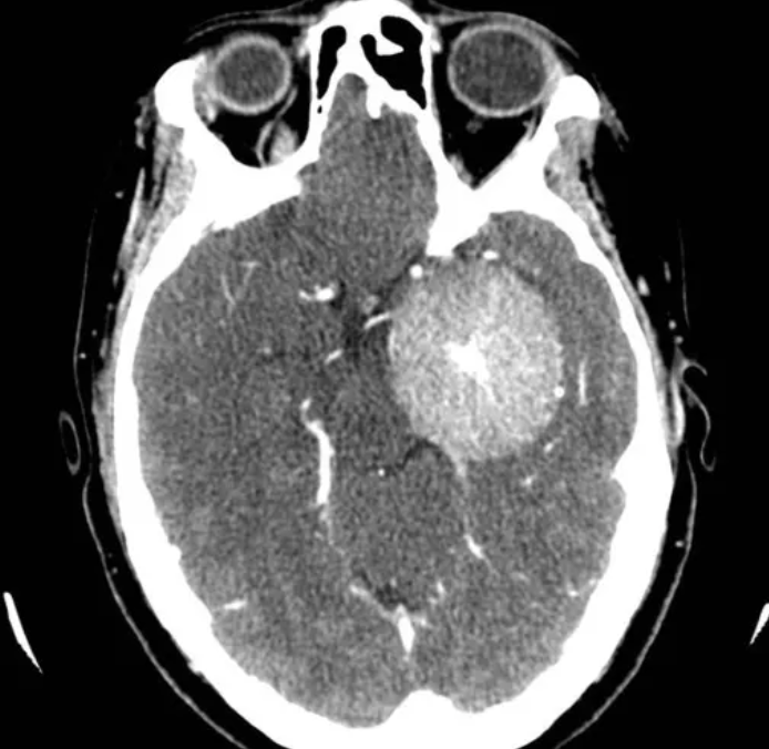 Midbrain Ct