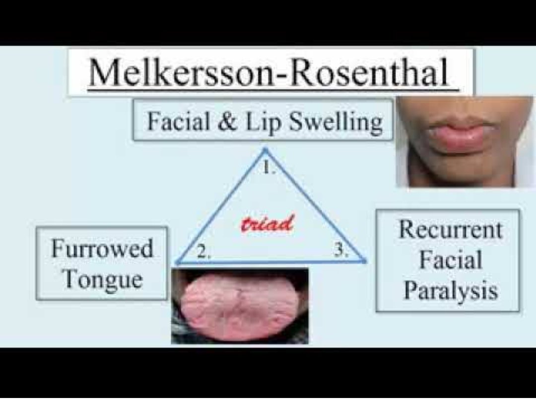 21-year-old female recurrent episodes of left-sided mouth deviation ...