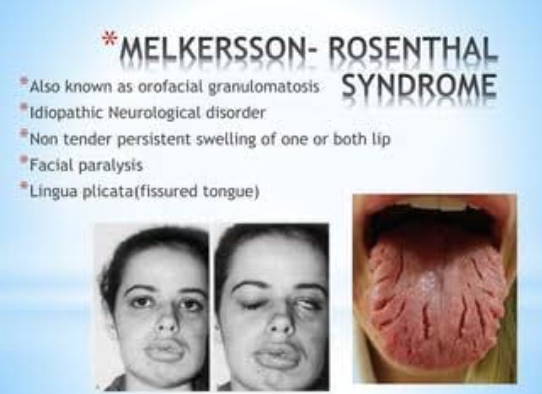 21-year-old female recurrent episodes of left-sided mouth deviation ...