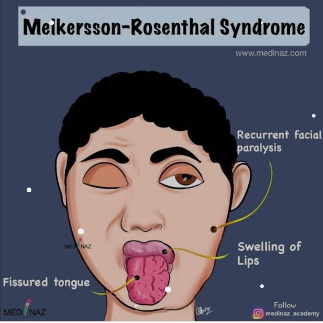 21-year-old female recurrent episodes of left-sided mouth deviation ...
