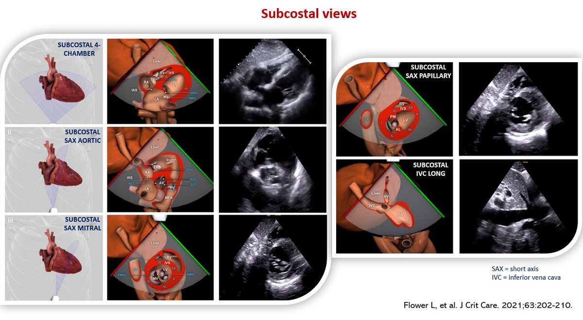 NephroPOCUS on Twitter: "I don’t have video but here is a nice article https://sciencedirect.com ...
