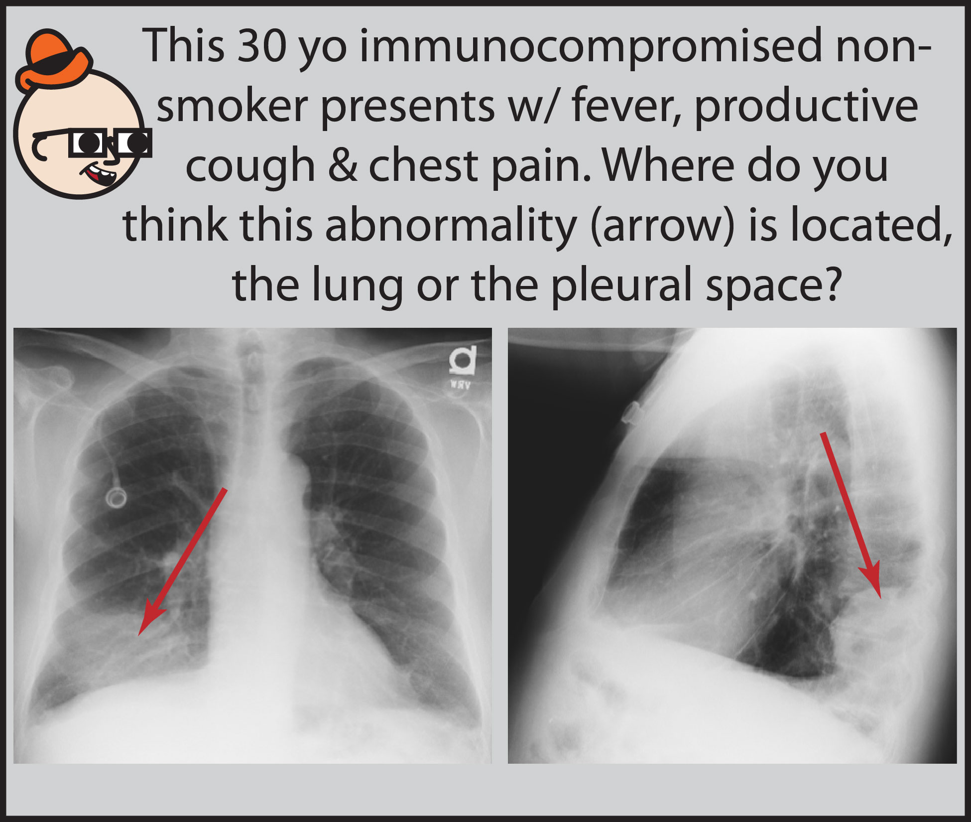 Chest X Ray Quotes Chest X Ray Basic Knowlege | PPT