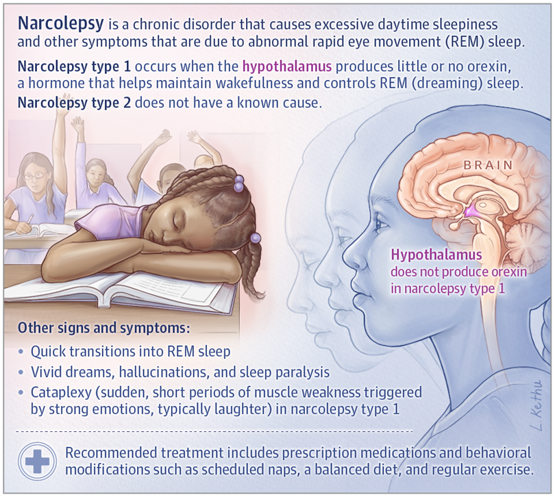 Narcolepsy Causes