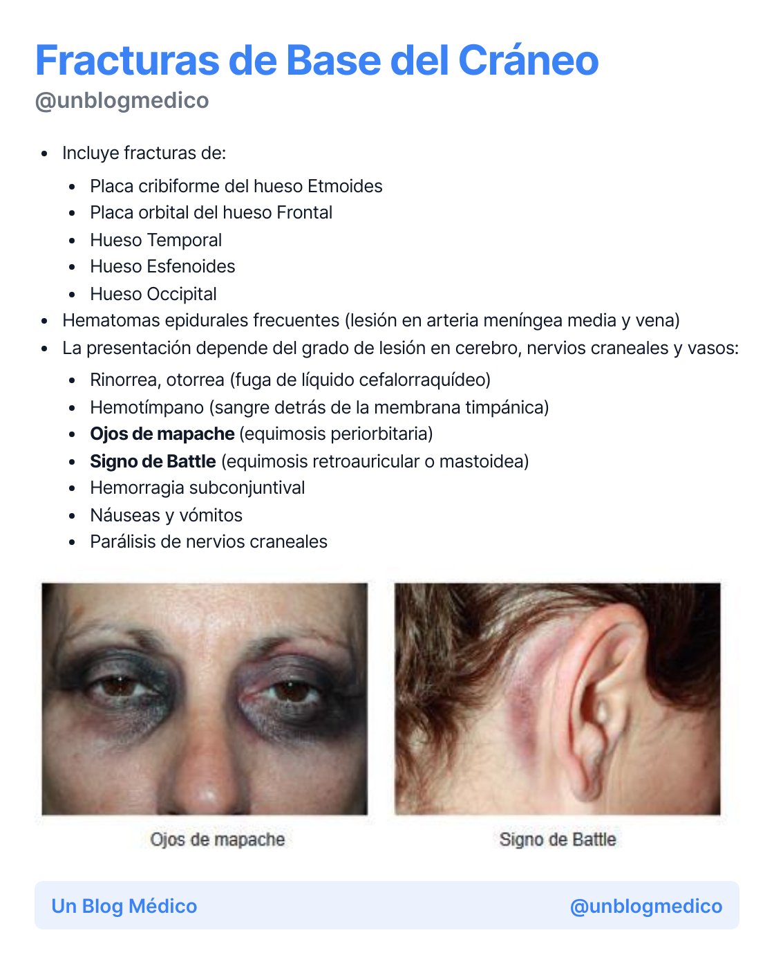 Equimosis Periorbitaria