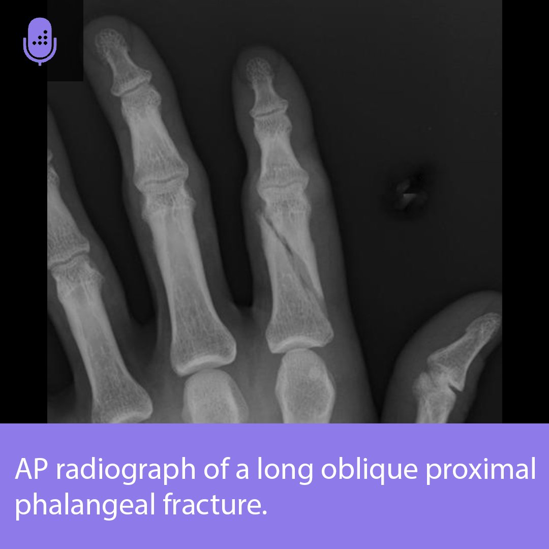 Proximal Phalanx Fracture
