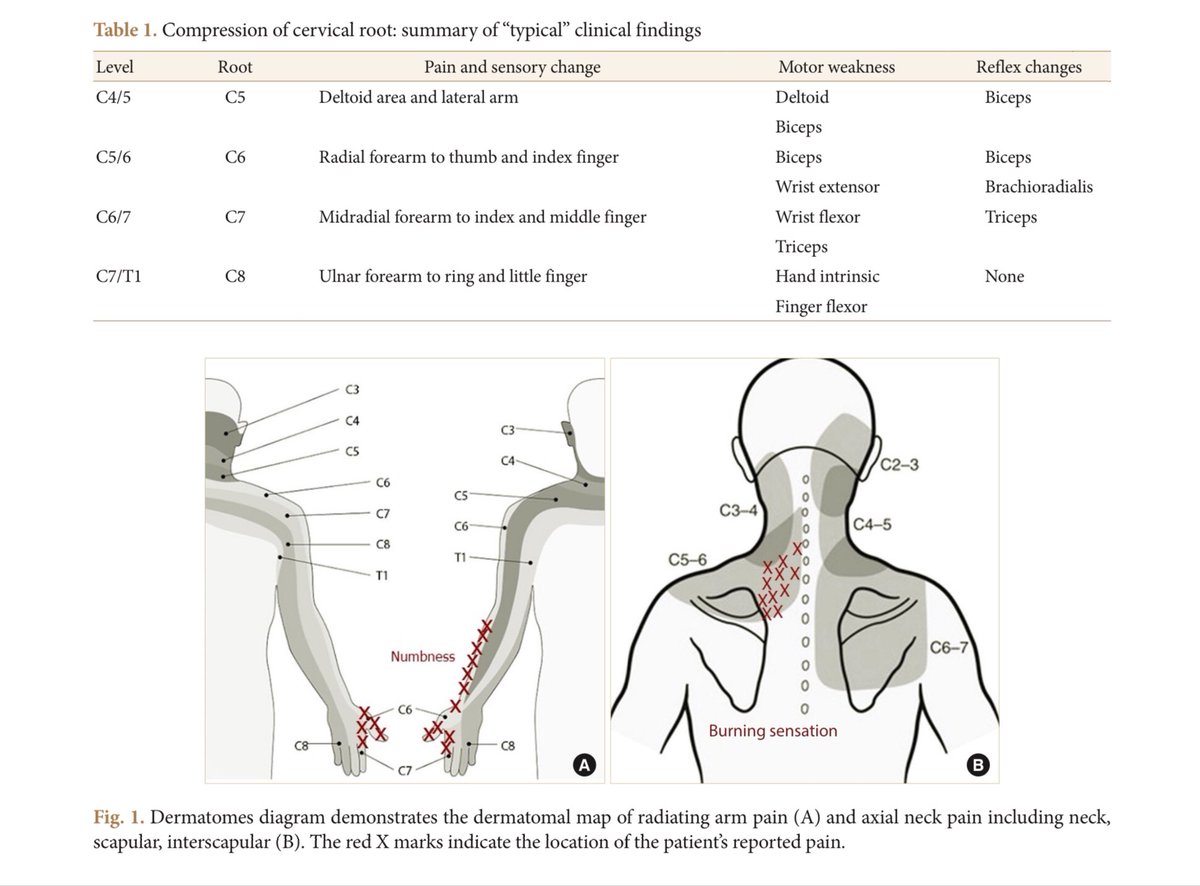 Cervical Radiculopathy Dermatomes