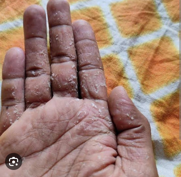 Peeling Skin On Palms Peeling Skin On Palms