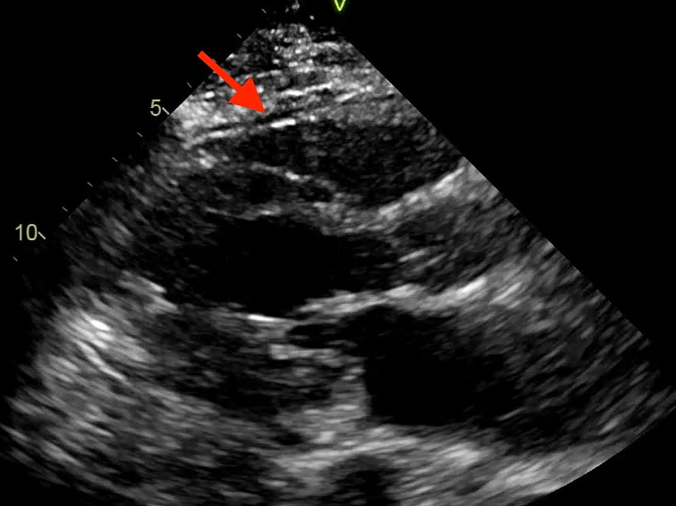 Adverse Reports On Twitter Acute Pericarditis After Moderna Booster adverse-reports-on-twitter-acute-pericarditis-after-moderna-booster
