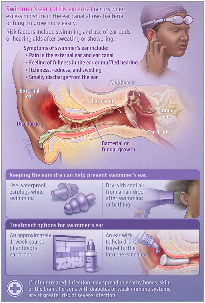 Swimmers Ear Diagram