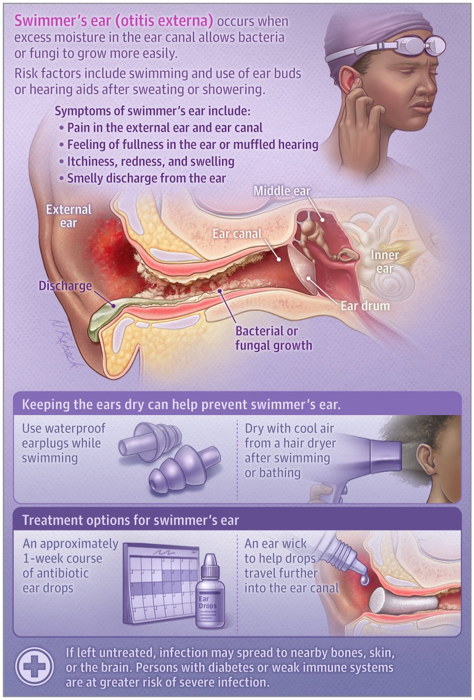 Fungal Otitis Externa Treatment