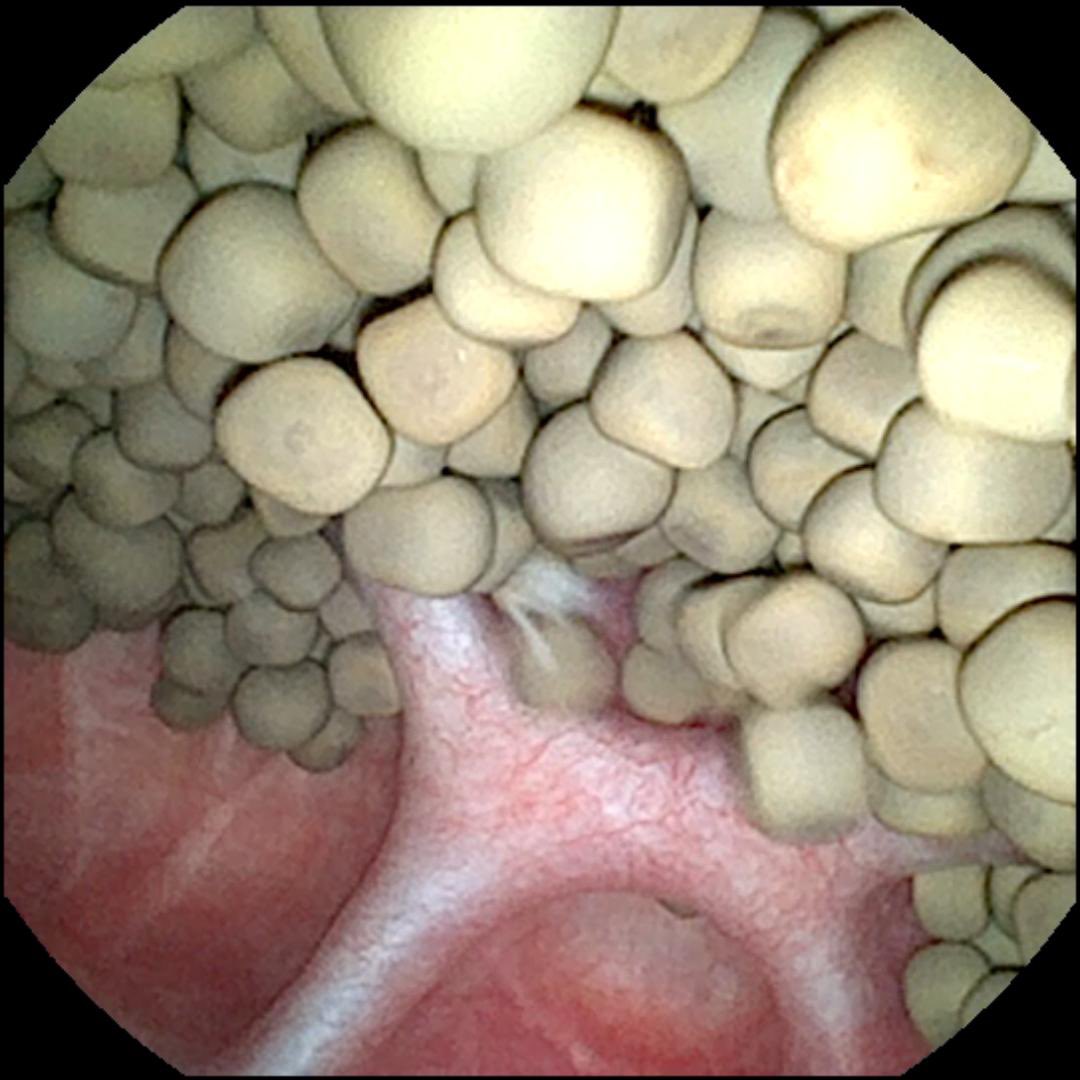 Smooth Kidney Stones