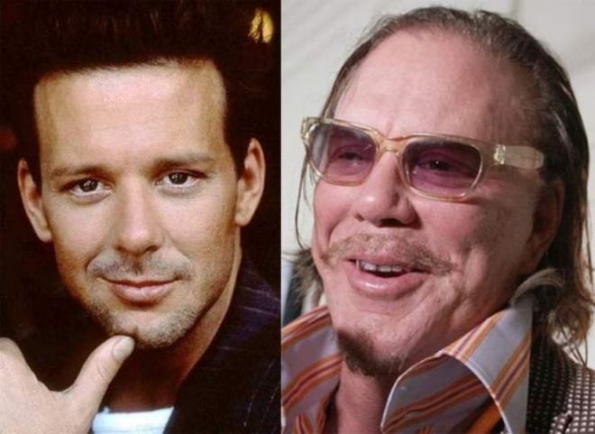Mickey Rourke Plastic Surgery Before And After