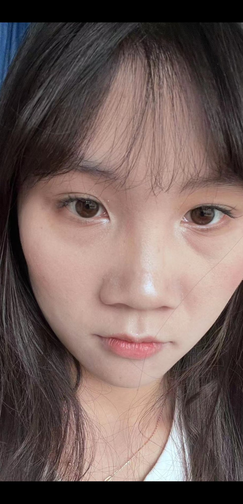 刘佳妮 on Twitter: "套餐三、雌JiSu：补佳乐1粒 +孕JiSu：甲羟孕酮1粒 +抗雄性药物：螺内酯1粒 =3粒 晚上睡前服用（副作用小，效果比较好！推荐！） https://t ...