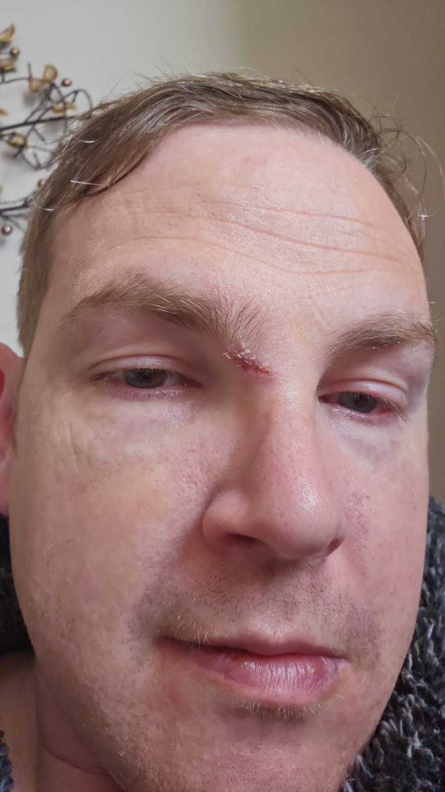 Cyst On Bridge Of Nose I Have A Spot Or Bump On The Nose What Could