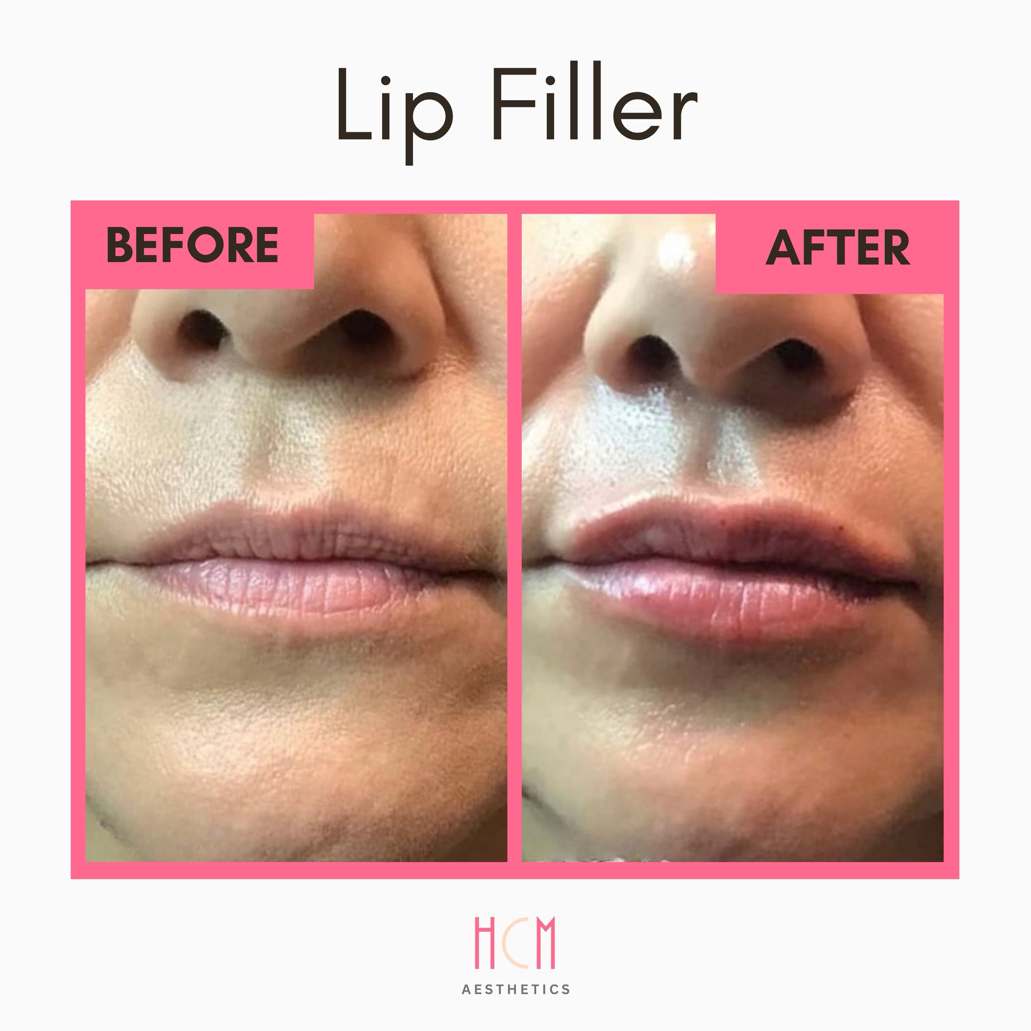 Hcm Aesthetics In Houston Tx On Twitter Dermal Fillers Are