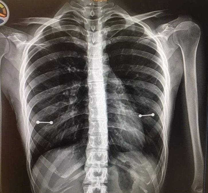 Giimaa 🥼 On Twitter Нурууны асуудалтай нөхдүүд хэр их байна Бүтэн нурууны зураг бариа засал