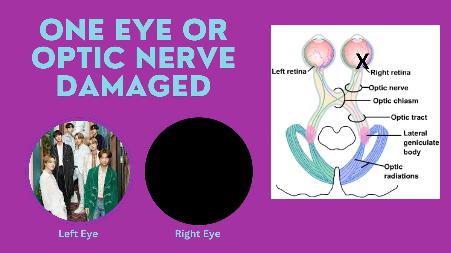 Optic Nerve Chiasm