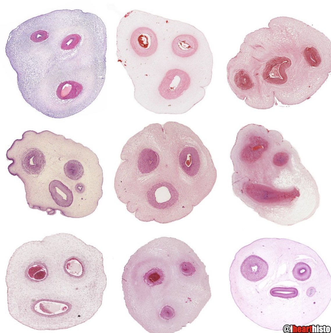 Umbilical Cord Cross Section Full Article: Contrast Enhanced