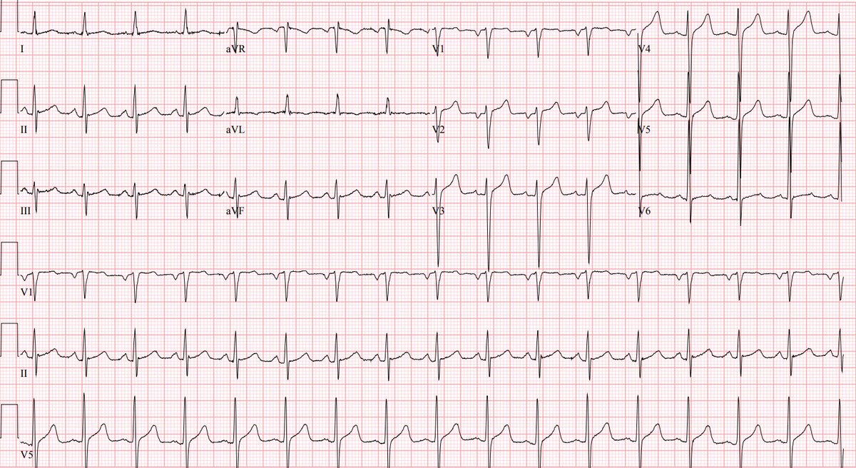 David Didlake On Twitter Late 30s M Hx Ckd And Htn With Known