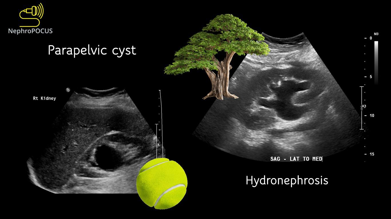 Hydronephrosis Ultrasound