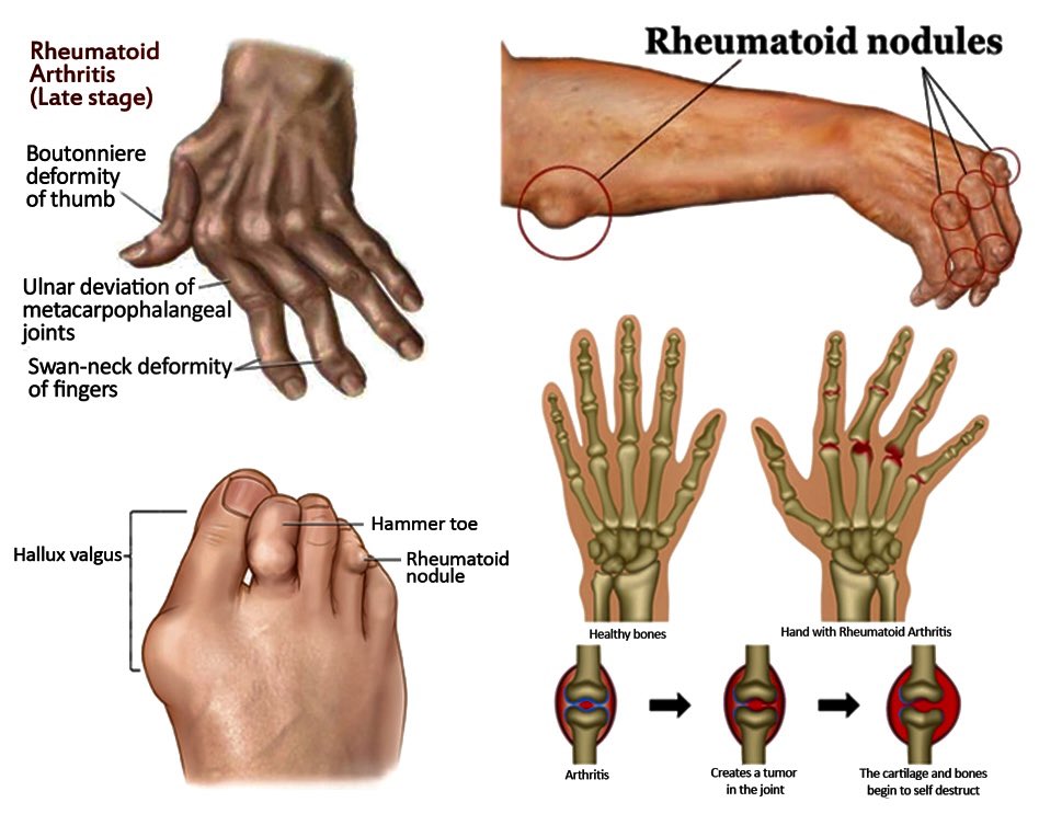 Rheumatoid Nodules Wrist