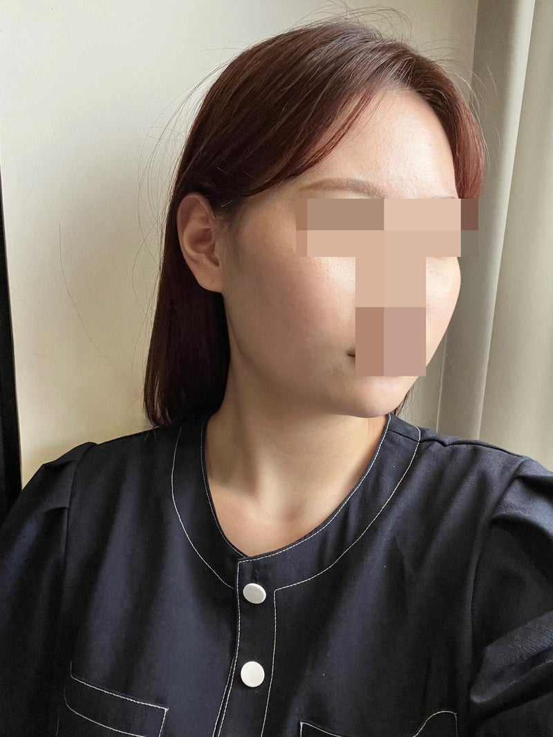 ナビコリア🍀 韓国美容整形🇰🇷 エージェンシー 2008年から~ on Twitter: "輪郭専門SODA美容外科で手術された方たちのリアルレビュー🥰 👉https://vo.la ...