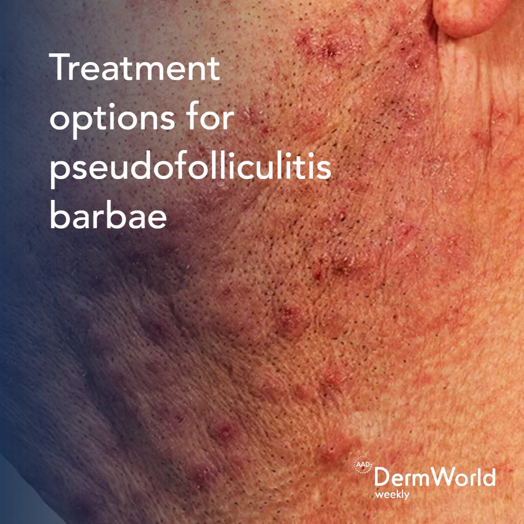 AADmember on Twitter: "A review published in Clinical and Experimental Dermatology details the ...