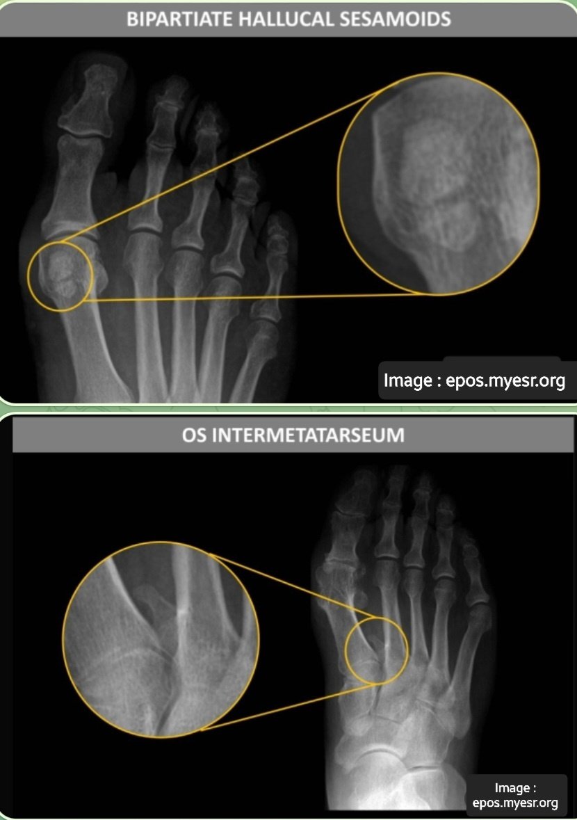 Sesamoiditis X Ray