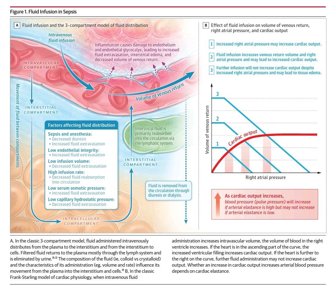 Fluid Therapy for Critically Ill Adults With Sepsis: A review @JAMA ...