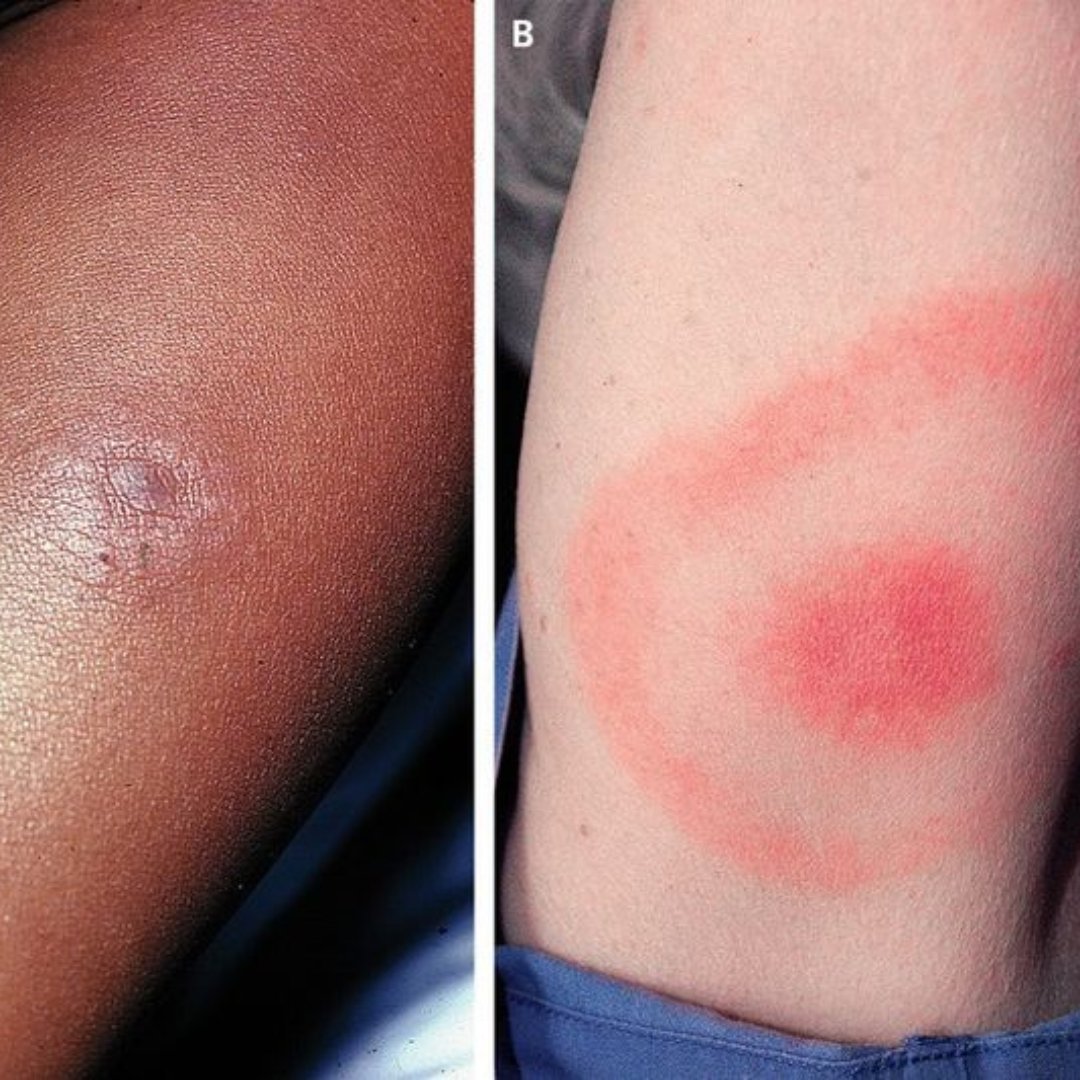 Lyme Disease Rash Neck