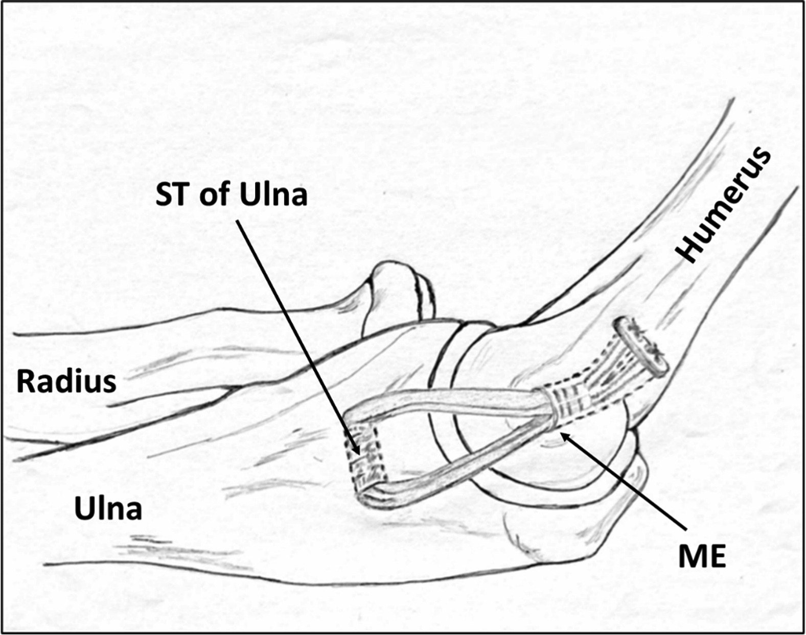 Collateral Ligament Elbow