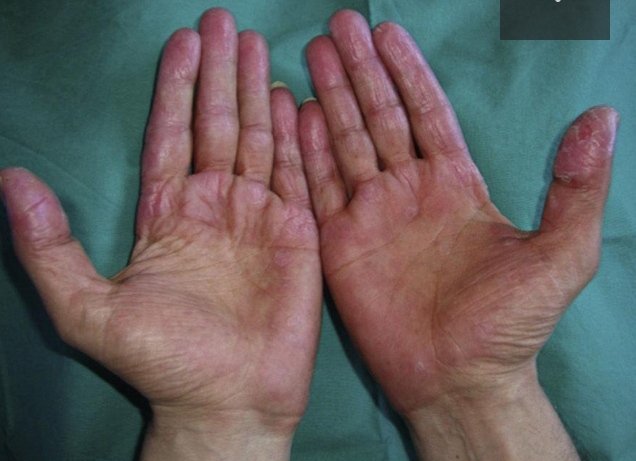 24 yr old female patient ... p/w general malaise, myalgias, & low-grade ...