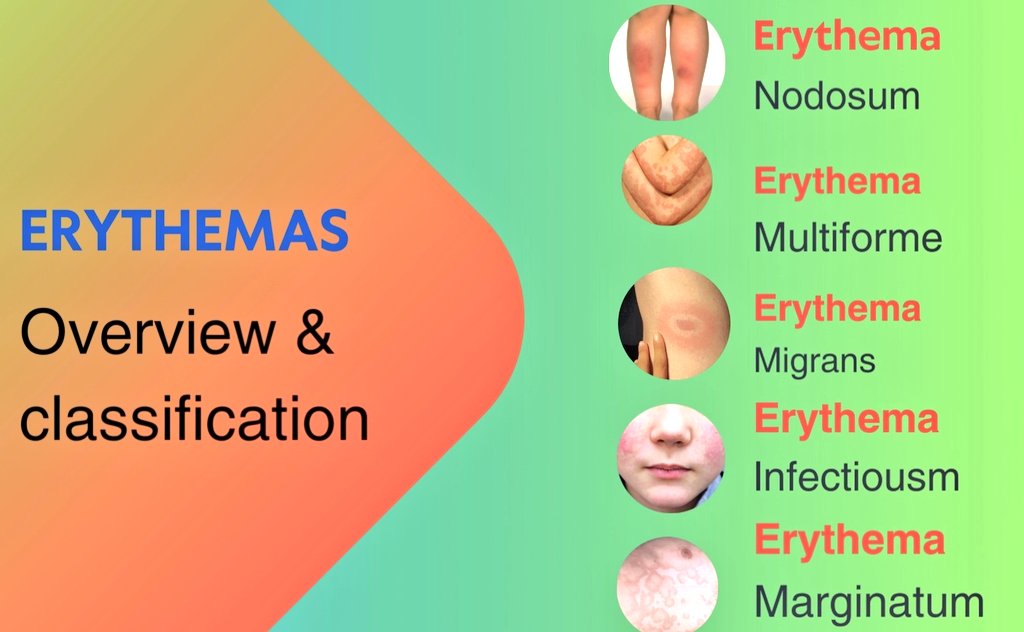 Erythema Marginatum Vs Erythema Multiforme