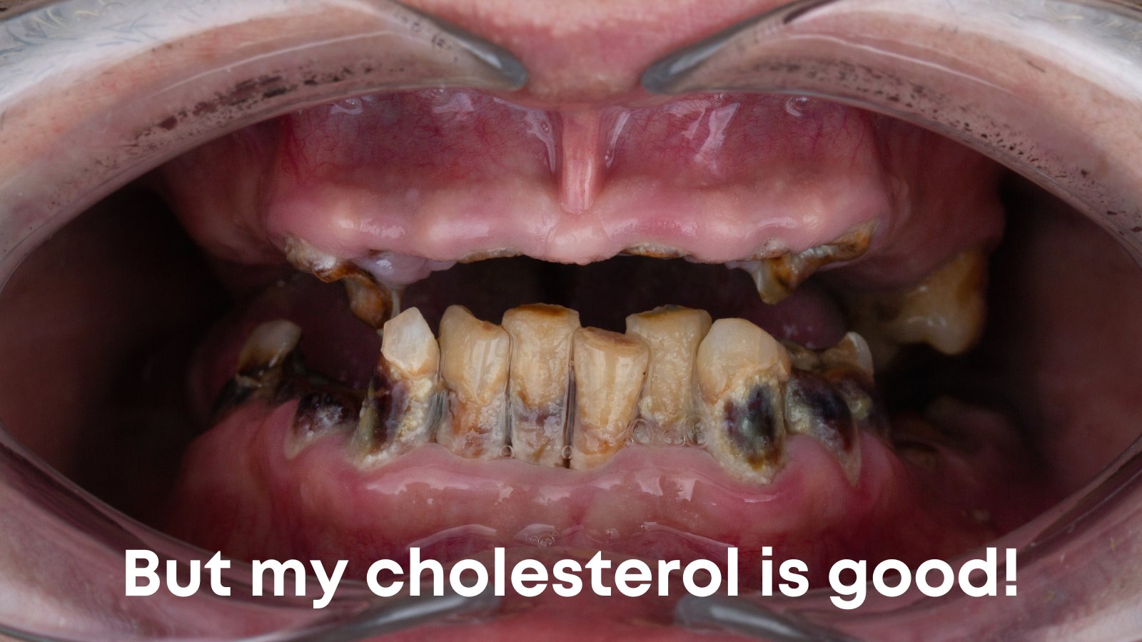 Gross Mouth Diseases