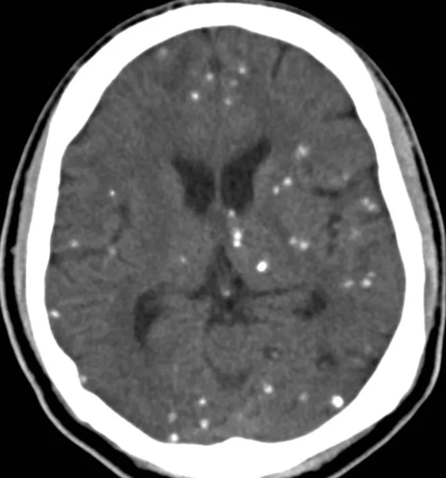 Radrounds Radiology Network On Twitter Diagnosis Answer Ow