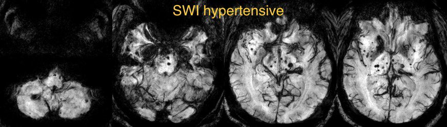 Hypertensive and cerebral amyloid angiopathy are 2 of the most common ...