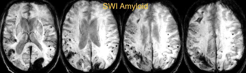 Hypertensive and cerebral amyloid angiopathy are 2 of the most common ...