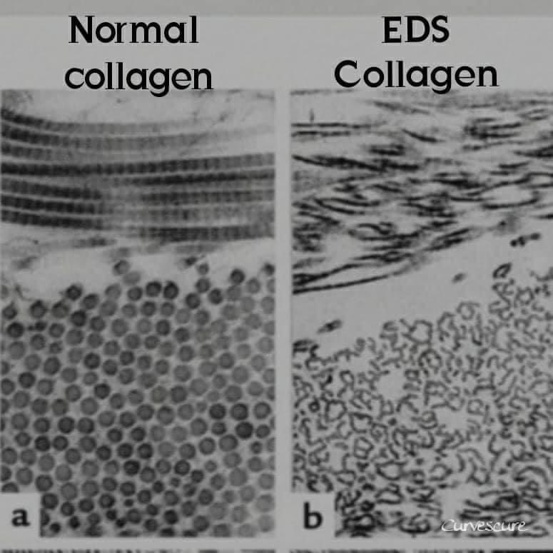 Anyone else starting to get frustrated with EDS and hypermobility being used interchangeably ...