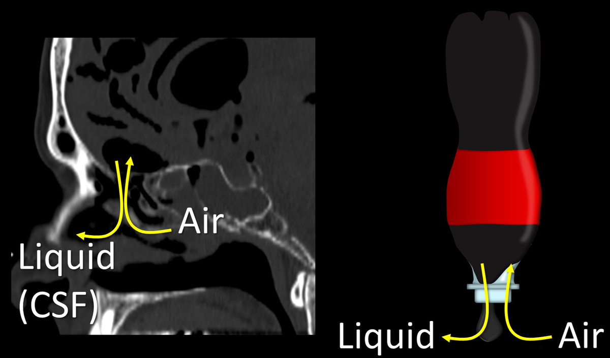 1/Controversy in radiology can get tense! The Mt Fuji sign for tension ...