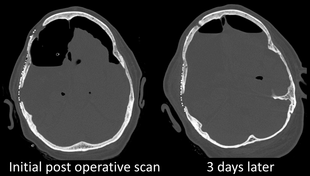 1/Controversy in radiology can get tense! The Mt Fuji sign for tension ...