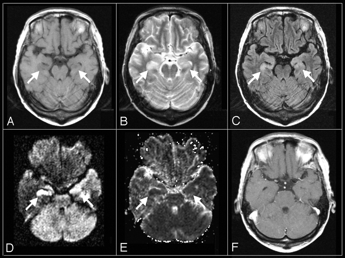 😱Complications in hematology😱 Human herpes virus 6 (HHV-6) infection A ...